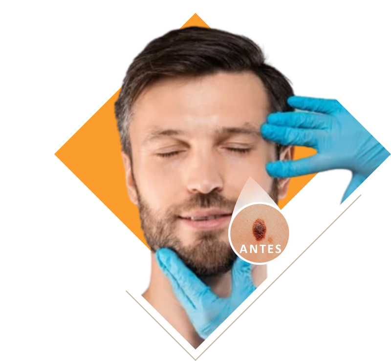 Exérese de Lesões de Pele – Clnica Beauty Time
